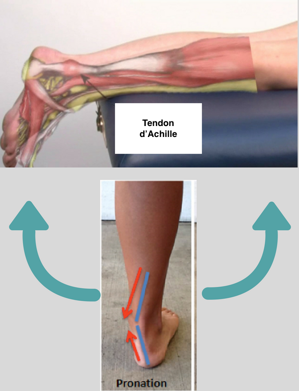 Tendinopathie d'Achille et pronation - Orthodynamica